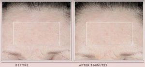 NuFACE FIX Line Smoothing Device Review