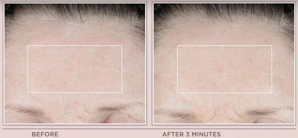 NuFACE FIX Line Smoothing Device Review NuFACE FIX Line Smoothing Device Review